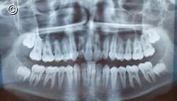 Terceiro Molar Incluso, Caso clínico | Ident