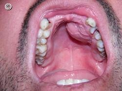 Abcesso Periapical Agudo, Caso clínico | Ident