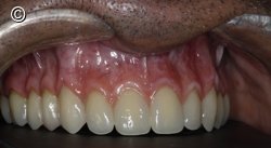 Reabilitação Estética e Funcional com Prótese Total Superior e Ppr ...