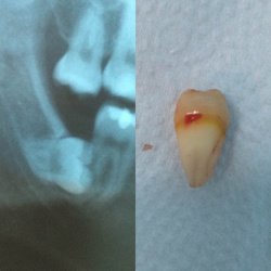 Terceiro Molar Incluso Impactado, Caso clínico | Ident