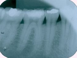 Tratamento Endodôntico Dente 46, Caso clínico | Ident