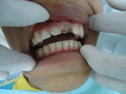 Tratamento Endodôntico no Elemento Dental 11 - Necropulpectomia, Caso ...