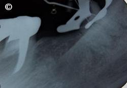 Tratamento Endodôntico do Dente 38., Caso clínico | Ident