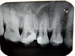 Endodontia do Dente 16, Caso clínico | Ident